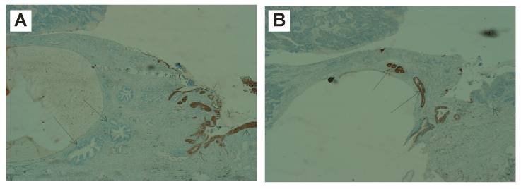 A Polypoid Cervical Neuroendocrine Carcinoma with Tumor Heterogeneity ...