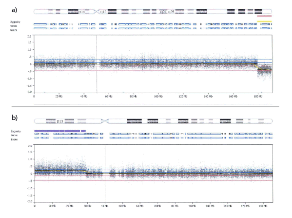 Distal Trisomy 10p and 4q Monosomy: Associated with Marfanoid Features ...