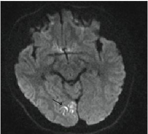 A Case of Severe Hand, Foot and Mouth Disease Accompanied by Visual ...