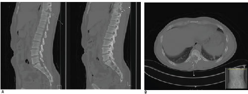 Tuberculous Diskitis Osteomyelitis: A Case Report