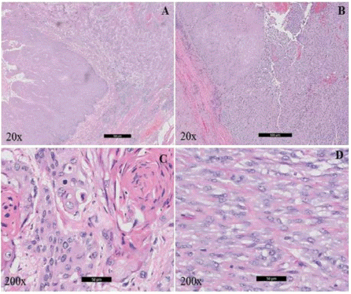 Renal Pelvis Squamous Cell Carcinoma with Sarcomatoid Transformation ...