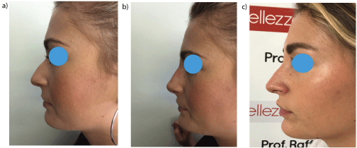 Evaluation of Different Depth Injections of Reticulated Hyaluronic Acid ...