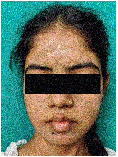 Dermatitis Neglecta: An oft Missed Diagnosis