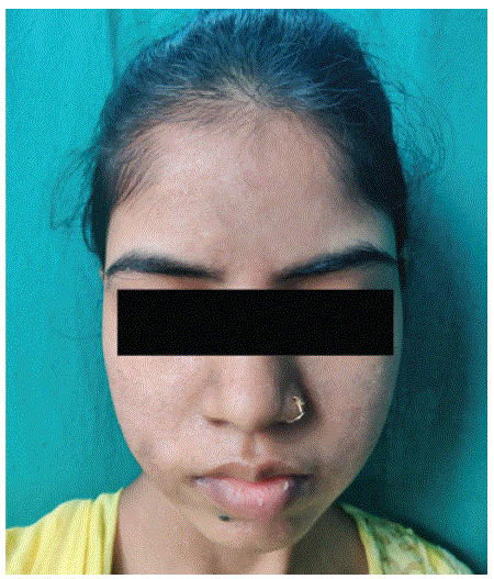 Dermatitis Neglecta: An oft Missed Diagnosis