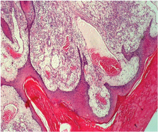 Multiple Large Pyogenic Granulomas Overlying a Burn: Case Report and ...