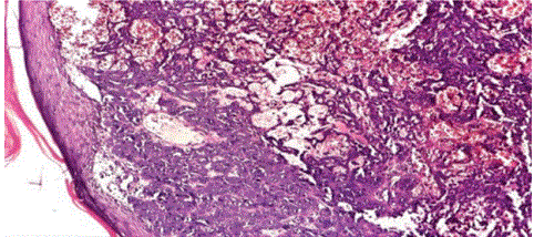 Squamous Cell Carcinoma on Discoid Lupus on Photo Protected Area