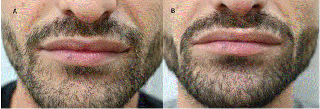 A Preliminary Report on the Safety and Efficacy of a Novel MaiLi HA ...