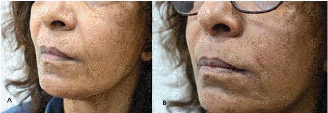 A Preliminary Report on the Safety and Efficacy of a Novel MaiLi HA ...