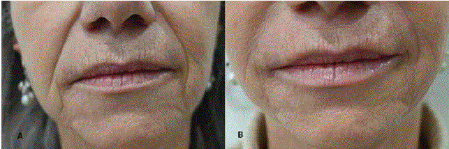 A Preliminary Report on the Safety and Efficacy of a Novel MaiLi HA ...