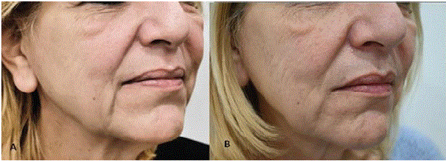 A Preliminary Report on the Safety and Efficacy of a Novel MaiLi HA ...