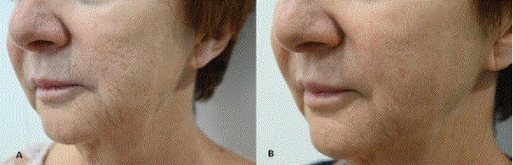 A Preliminary Report on the Safety and Efficacy of a Novel MaiLi HA ...