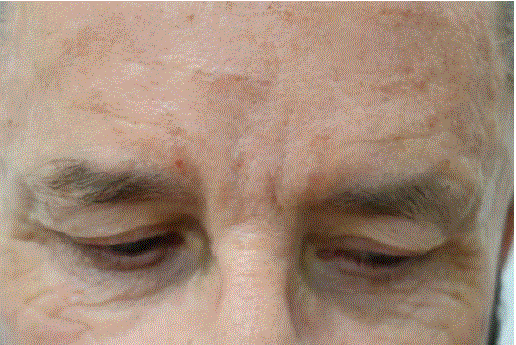 A Preliminary Report on the Safety and Efficacy of a Novel MaiLi HA ...