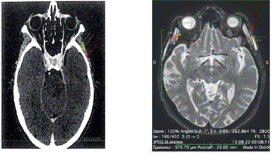 Long-Term Follow-Up of the Behavior of Facial Volumizing Cross-Linked ...