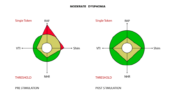 Pre and Post Stimulation Results for Dysphonic Participants on the ...