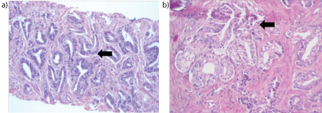 Reporting of Prostatic Adenocarcinoma in Needle Biopsies-Gleason’s ...