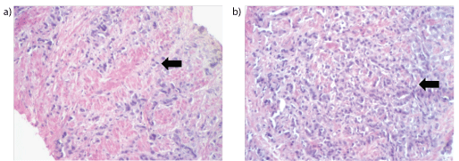 Reporting of Prostatic Adenocarcinoma in Needle Biopsies-Gleason’s ...