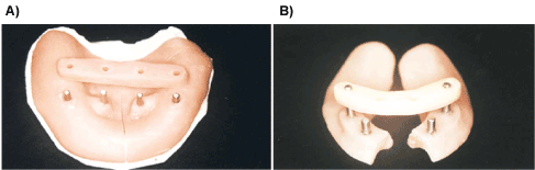 Impression Techniques for Microstomia Patients: No longer Cumbersome ...