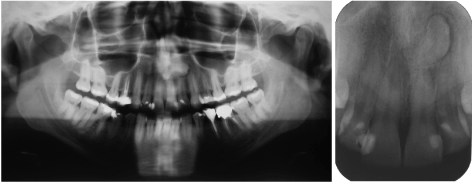 Severe Sequelae After A Mesiodens Surgical Removal: A Clinical Report