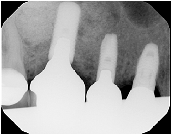 A Novel Approach to Treat Large Schneiderian Membrane Perforation -A ...