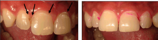 Clinical Observations on the Remineralization of Stage 1 Enamel Caries Lesions Using a TrayBased ...