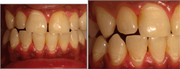 Clinical Observations on the Remineralization of Stage 1 Enamel Caries Lesions Using a TrayBased ...
