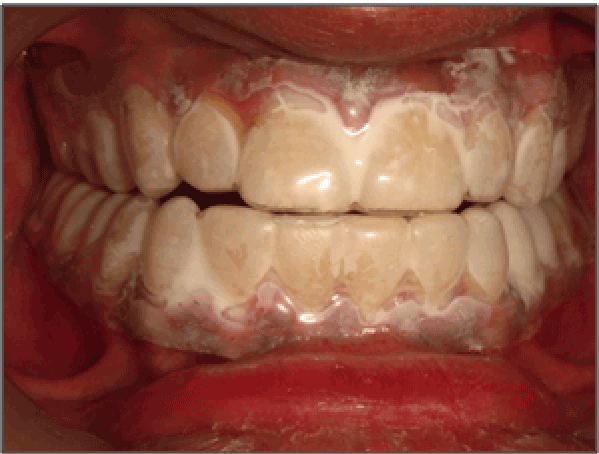 Clinical Observations on the Remineralization of Stage 1 Enamel Caries Lesions Using a TrayBased ...