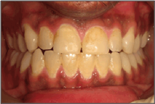 Clinical Observations on the Remineralization of Stage 1 Enamel Caries ...
