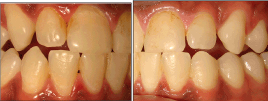 Clinical Observations on the Remineralization of Stage 1 Enamel Caries ...