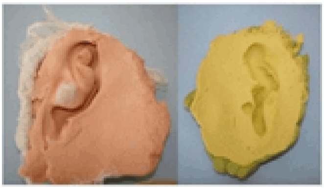 Reconstruction of Auricular Defect with Adhesive - Retained Silicone ...