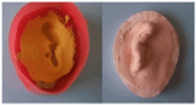 Reconstruction of Auricular Defect with Adhesive - Retained Silicone ...
