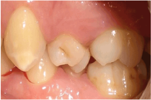 Gallium Arsenide Aluminium Laser in Esthetic Dentistry