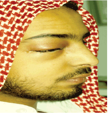 Orbital Cellulitis and Orbital Abscess of Odontogenic Origin: Two Case ...