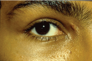 Orbital Cellulitis and Orbital Abscess of Odontogenic Origin: Two Case ...