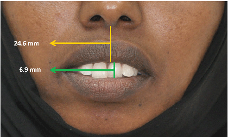 Clinical Parameters of the Gummy Smile among Sudanese Female Sample