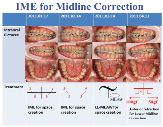 ISW for the Treatment of Functional Class III Malocclusion by Crossbite ...