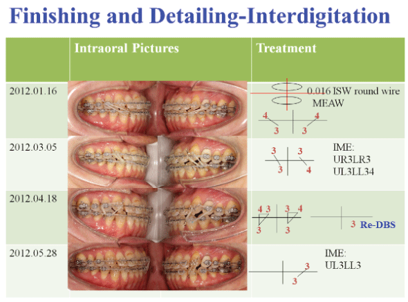 ISW for the Treatment of Functional Class III Malocclusion by Crossbite ...