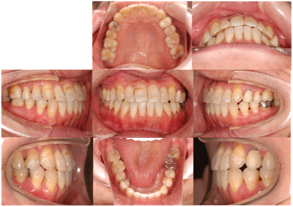 ISW for the Treatment of Functional Class III Malocclusion by Crossbite ...