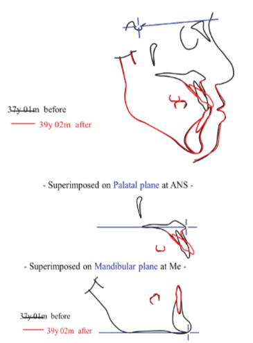 ISW for the Treatment of Functional Class III Malocclusion by Crossbite ...