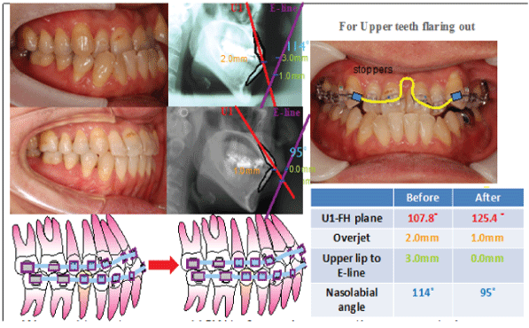 ISW for the Treatment of Functional Class III Malocclusion by Crossbite ...