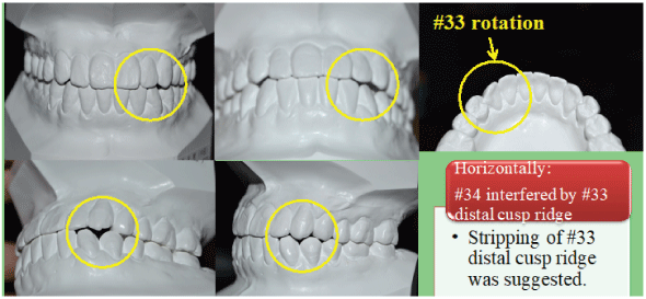ISW for the Treatment of Functional Class III Malocclusion by Crossbite ...