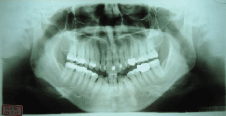 ISW for the Treatment of Functional Class III Malocclusion by Crossbite ...