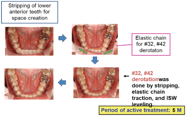 ISW for the Treatment of Functional Class III Malocclusion by Crossbite ...