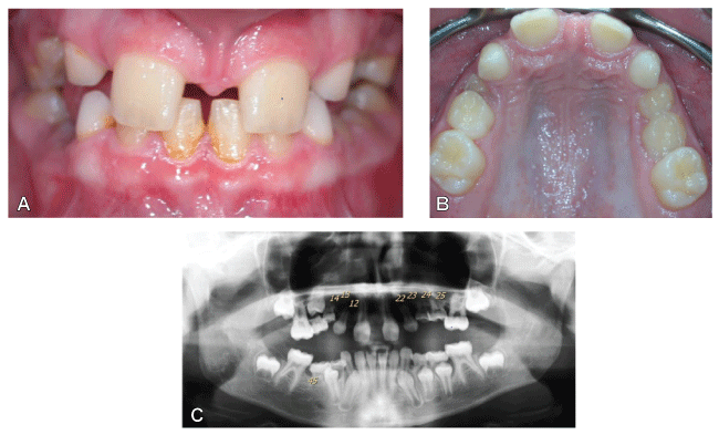 Case Report: Multiple Tooth Agenesis-A Re-Update after 11 Years