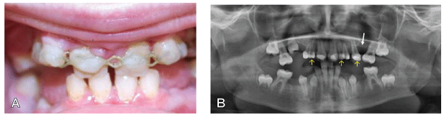 Case Report: Multiple Tooth Agenesis-A Re-Update after 11 Years