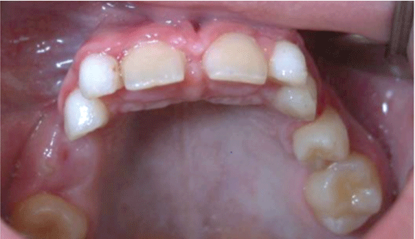 Case Report: Multiple Tooth Agenesis-A Re-Update after 11 Years