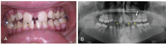 Case Report: Multiple Tooth Agenesis-A Re-Update after 11 Years