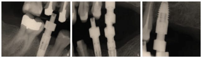 Treatment Phasing: A Simplified Approach for Complex Case Management