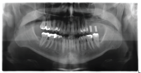 Augmentation/Transplantation in Periodontally Compromised Dentition