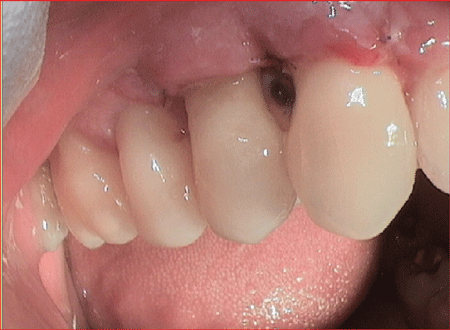 Augmentation/Transplantation in Periodontally Compromised Dentition