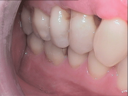Augmentation/Transplantation in Periodontally Compromised Dentition